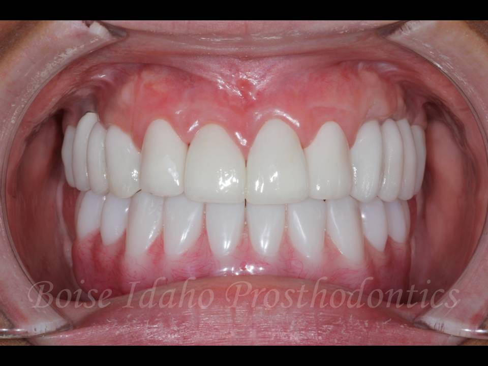 Boise Idaho Prosthodontics: Ectodermal Dysplasia Completed Treatment