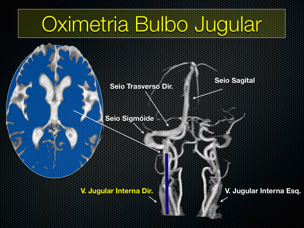 NEUROINTENSIVISMO: Aspectos Técnicos Oximetria Jugular