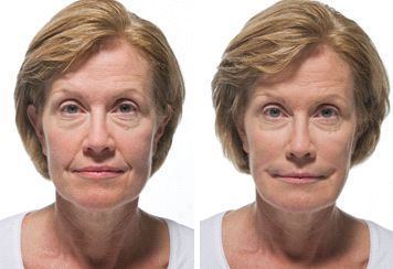 A Facial Exercise Toning Program That Results In Natural Facelifts