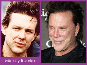 Mickey Rourke Plastic Surgery