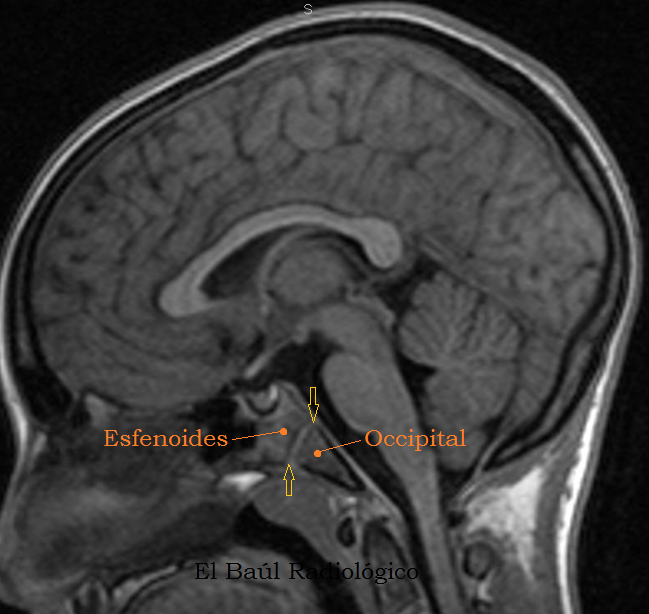 El Baúl Radiológico: SINCONDROSIS ESFENOBASILAR. (Sphenobasilar ...