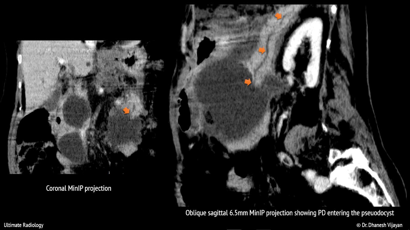 Ultimate Radiology : Pancreatic pseudocyst with duct communication (CT)