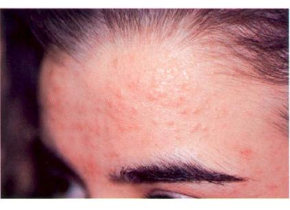 How To Remove Warts On Face - Moles, Warts & Skin Tags Removal