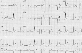 Ectopic Atrial Rhythm