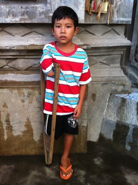 Bali Street Kids: Dana - Boy with 1 arm and 1 leg