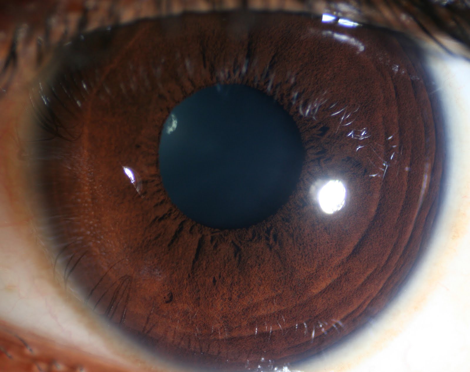 Modern & Multidimensional Iridology: Solitary Melanin Pigment at Inner ...