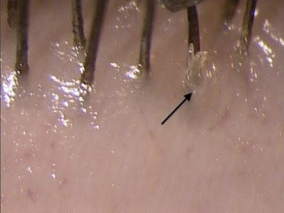 eyecing on the cake: Demodex