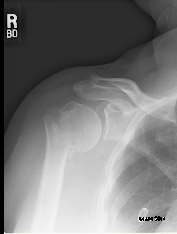 Shoulder and Elbow Surgery: Corrective osteotomy for surgical neck ...