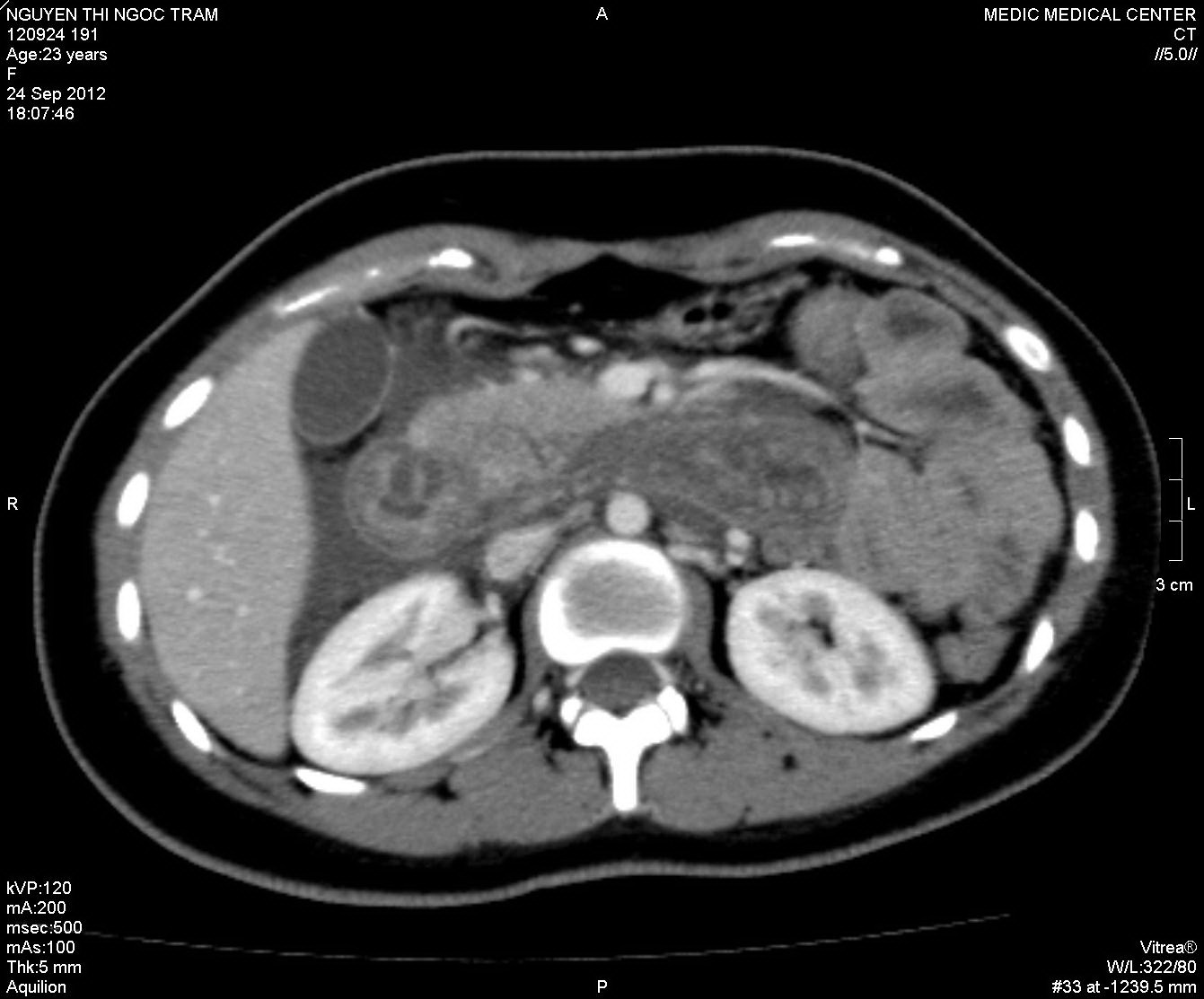 VIETNAMESE MEDIC ULTRASOUND: CASE 141: RUPTURE of DUODENUM, Dr PHAN ...