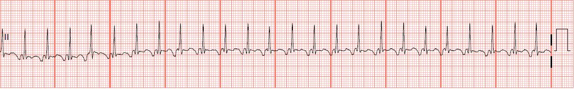 EKG Rhythm Strips 27: Atrial Rhythms