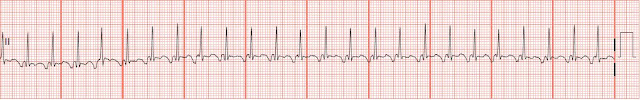 EKG Rhythm Strips 27: Atrial Rhythms