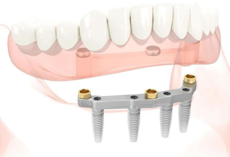 Implant-Supported Dentures (Overdentures)