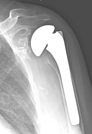 UW Shoulder and Elbow Academy: Total shoulder - tuberosity fracture and ...