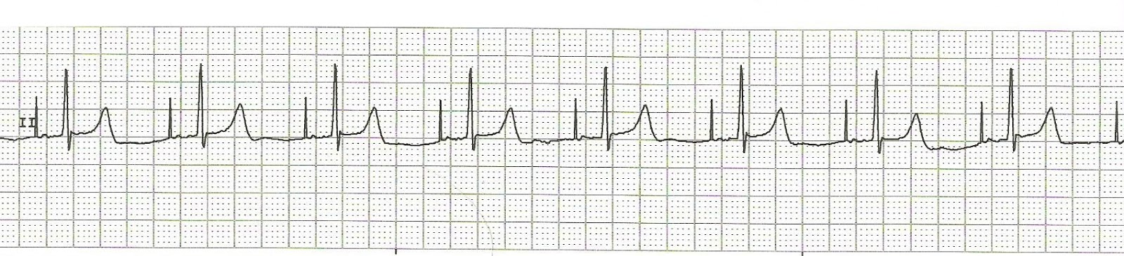 EKG Rhythm Strip Quiz 62