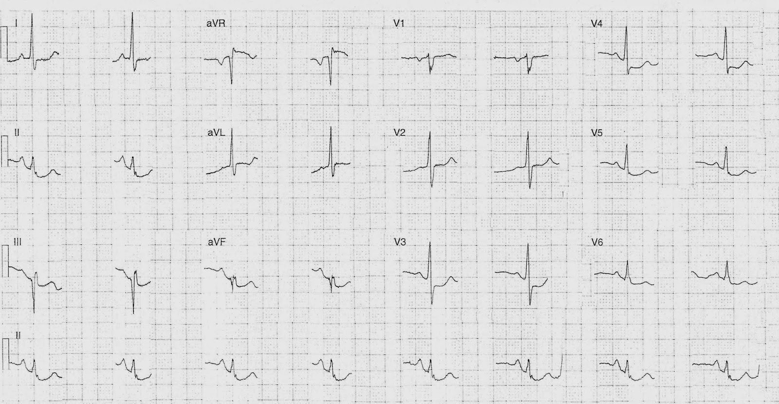 ECG of the Week: ECG of the Week - 20th April 2015 - Interpretation