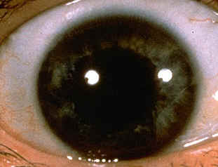 Images For Kayser Fleischer (KF) Ring - Wilson's Disease ~ YOUNG ...