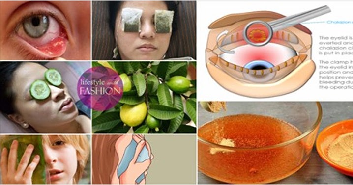 Home Remedies for Eyelid Cysts (Chalazions) ~ Entertainment News ...