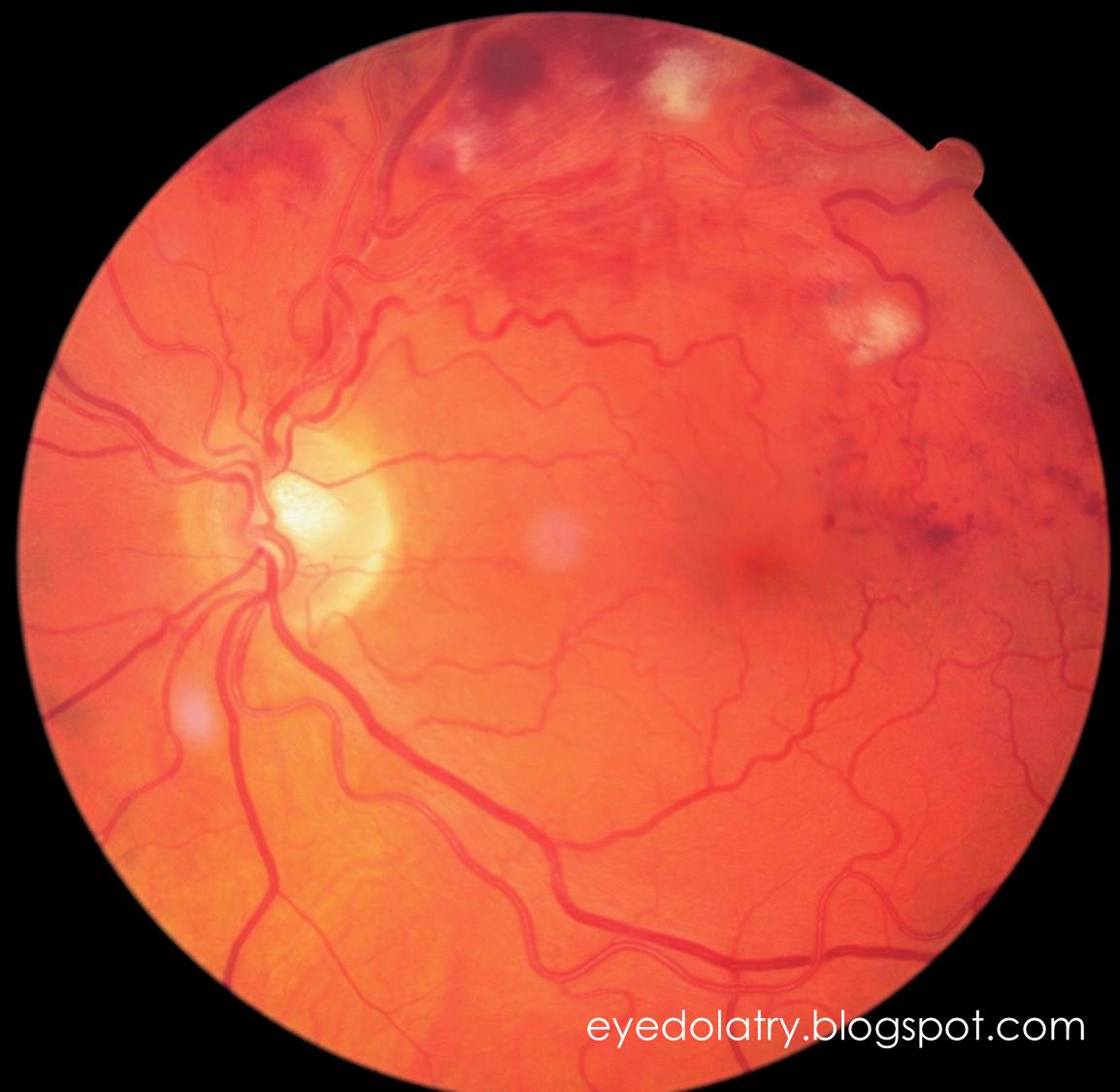 Retinal Photography II - Eyedolatry