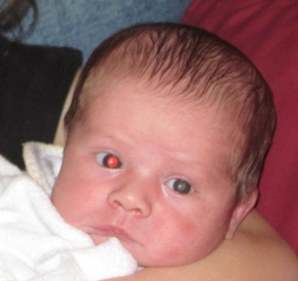 Tommy's Eyes: Red Reflex