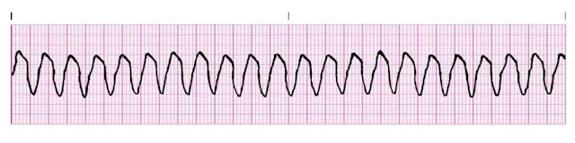 Dr. Smith's ECG Blog: Polymorphic Ventricular Tachycardia