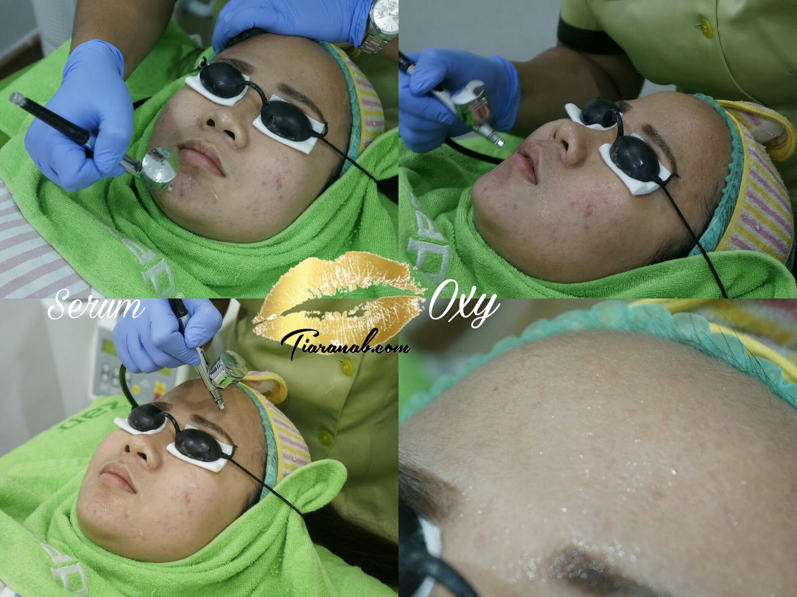 [Beauty Report + Review ] ZAP PREMIER & ZAP Photo Facial Review | Tiaranab