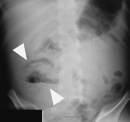 ON - RADIOLOGY: Ruptured Appedicitis in abdominal X-ray