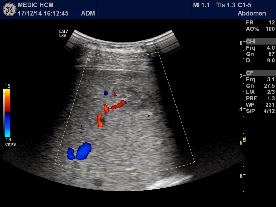 VIETNAMESE MEDIC ULTRASOUND: CASE 289: GRAPE'S SIGN in LIVER, Dr PHAN ...