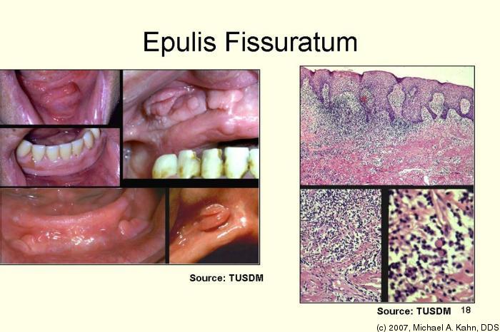dentalivre: Tumeurs bénignes de la muqueuse buccale : Les pseudo ...