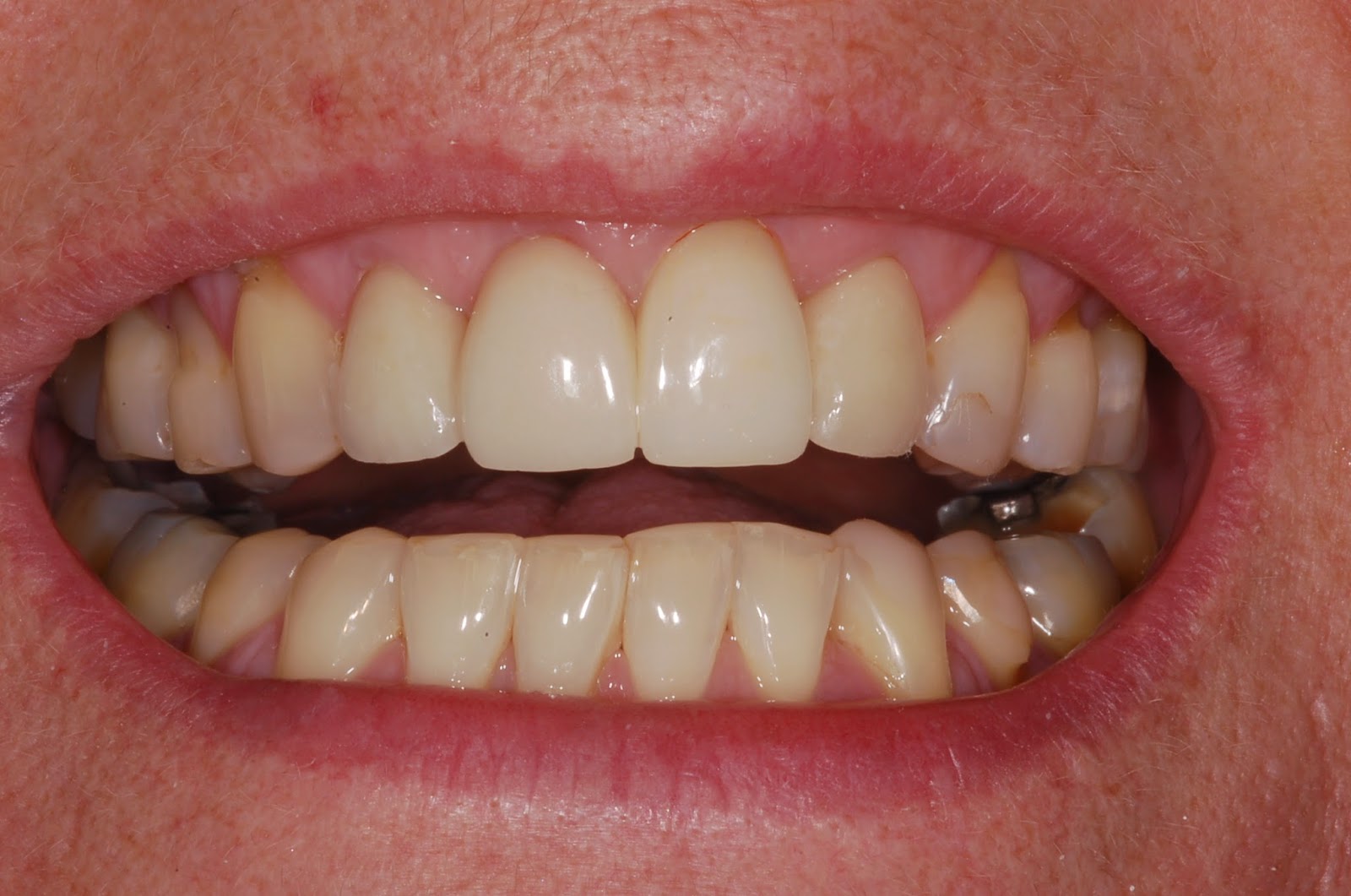 Single front crown - Bauer Smiles