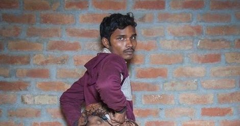 WELCOME TO JIBRIL BELLO'S BLOG: Man Born With Two Extra Legs On His ...