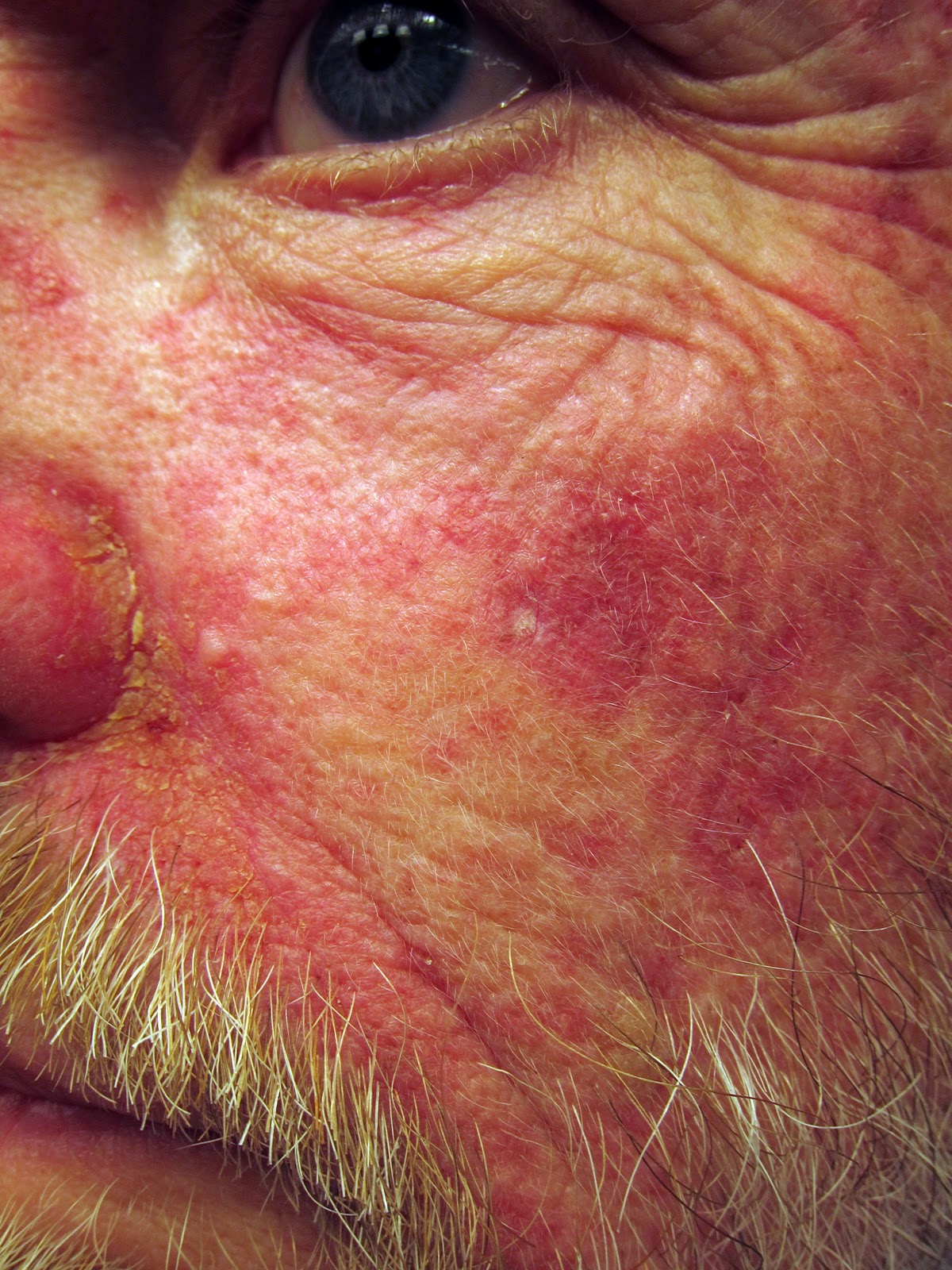 Efudex - Round Two: Day 14 - Fully Cooked!