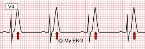 hiperpotasemia hiperkalemia leve moderada