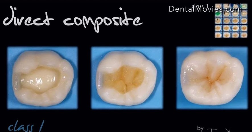 OPERATIVE DENTISTRY: Posterior Direct Composite - Class 1 - Technique ...