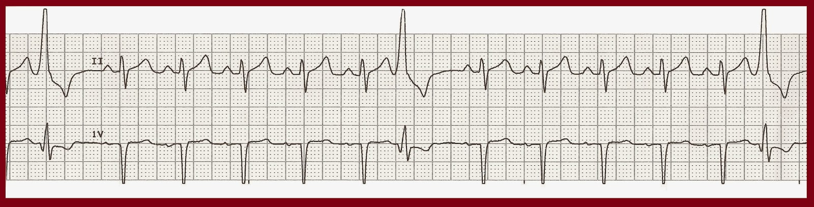 Practice Rhythm Strips 238