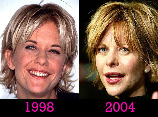 Chatter Busy: Meg Ryan Plastic Surgery