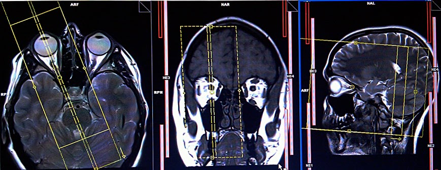 MRI Protocols: ORBIT MRI PLANNING REFERRAL LINES , MRI ORBIT TECHNIQUES