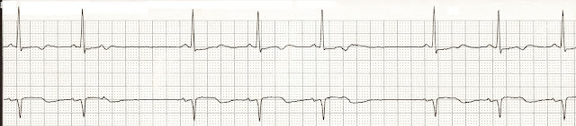 EKG Rhythm Strips 15: Sinus Rhythms