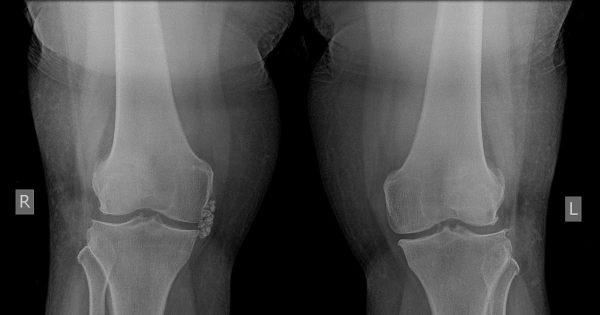 Emergence Phenomena: Not the bees' knees