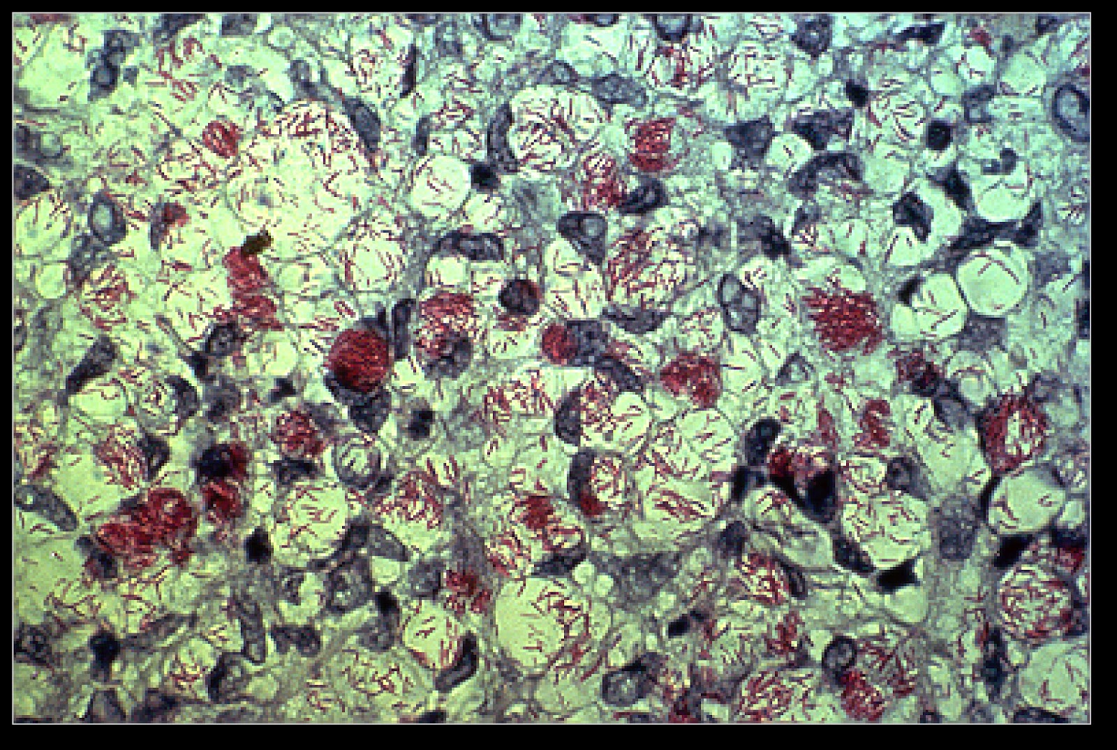 Leprosy | The Ultimate Curiosity