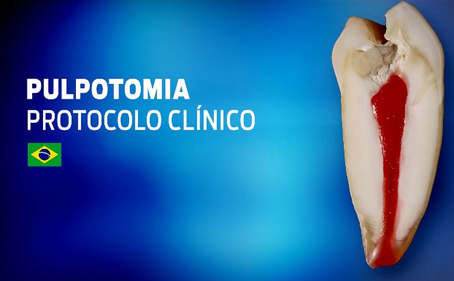 PULPOTOMIA: Protocolo Clínico - Leonardo Muniz - Odonto-Tv