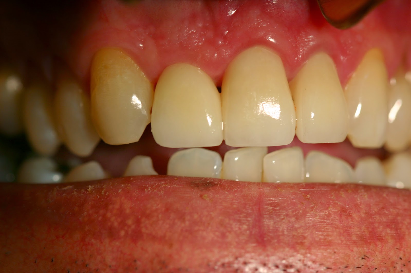 Amazing (Uneven) Front Teeth - Robert G. Tupac, D.D.S., F.A.C.P ...