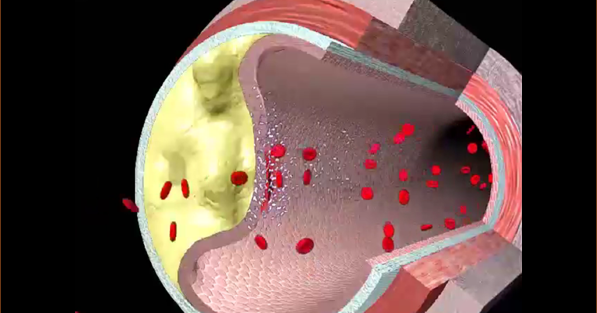 CULTURE SCIENCE : Ejercicio Físico y Apoplejía cerebral (Stroke)