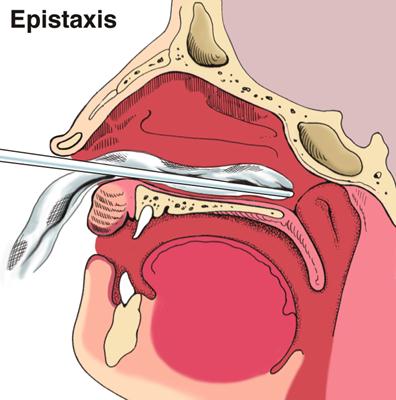 ENT for medical students: NOSE - Epistaxis