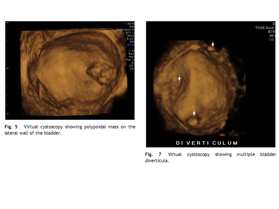 BÀI SOẠN VỀ SIÊU ÂM CHẨN ĐOÁN: VIRTUAL CYSTOSCOPY USING 3D ULTRASOUND