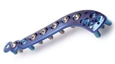 Titanium Rib Plating Photos Of My Surgery Video