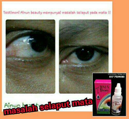 Testimoni Selaput Mata (EBP) | Rahsia Mata