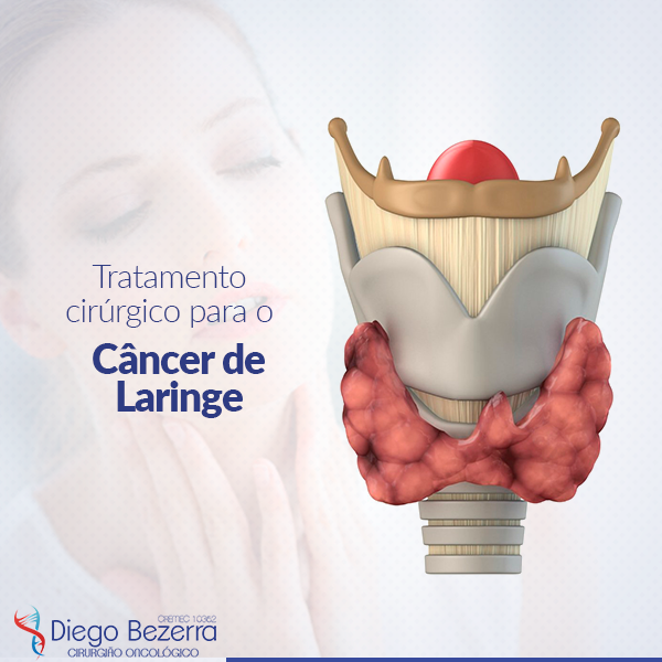 BLOG ENCONTRO COM A SAÚDE DE SOBRAL: Câncer de Laringe - Dr. Diego ...