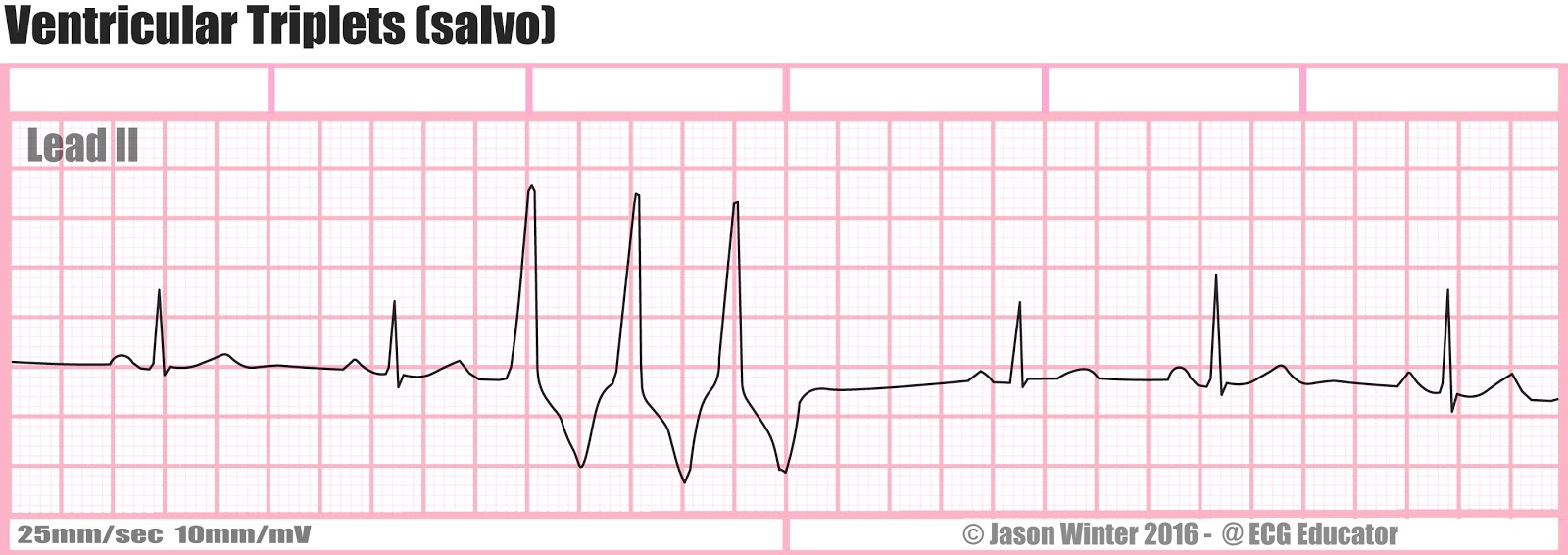 ECG Educator Blog : Six Second ECG Rhythm Strips