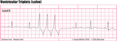 ECG Educator Blog : Six Second ECG Rhythm Strips