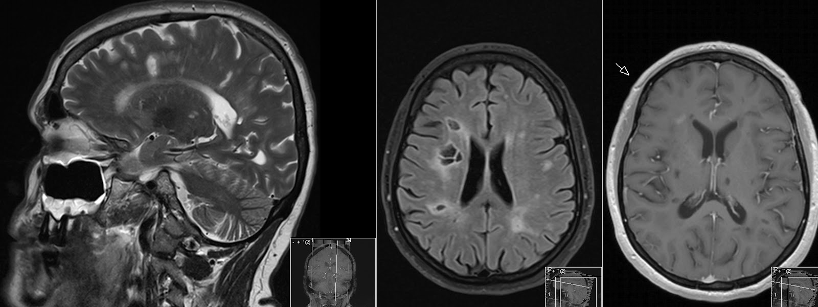Radiology MRI: DWI Restriction in MS